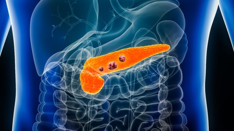 Dealing with Pancreatic Cancer- Essential Information for Patients and ...